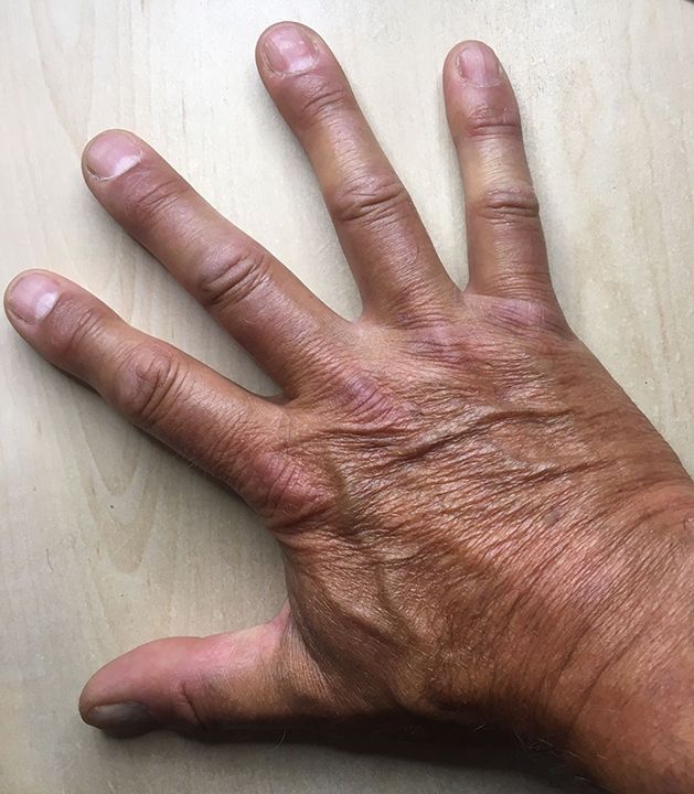 Gap Between Fingers: A Quick And Easy Guide To Understand Their ...